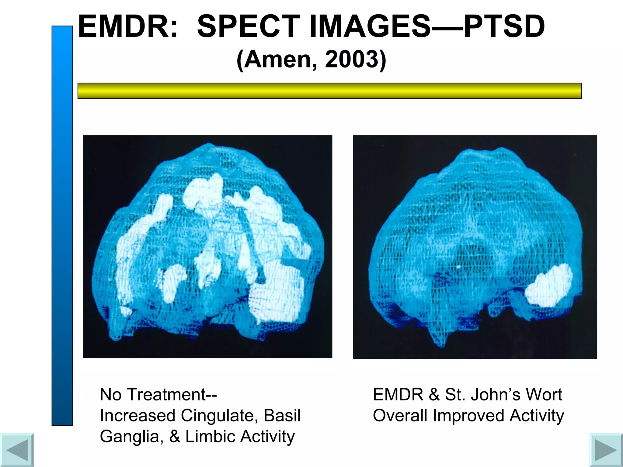 Emdr Presentation | PPT