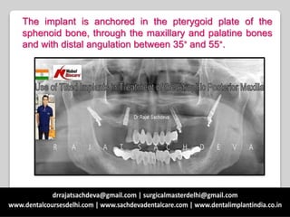 Emergence of pterygoid implants | PPTX