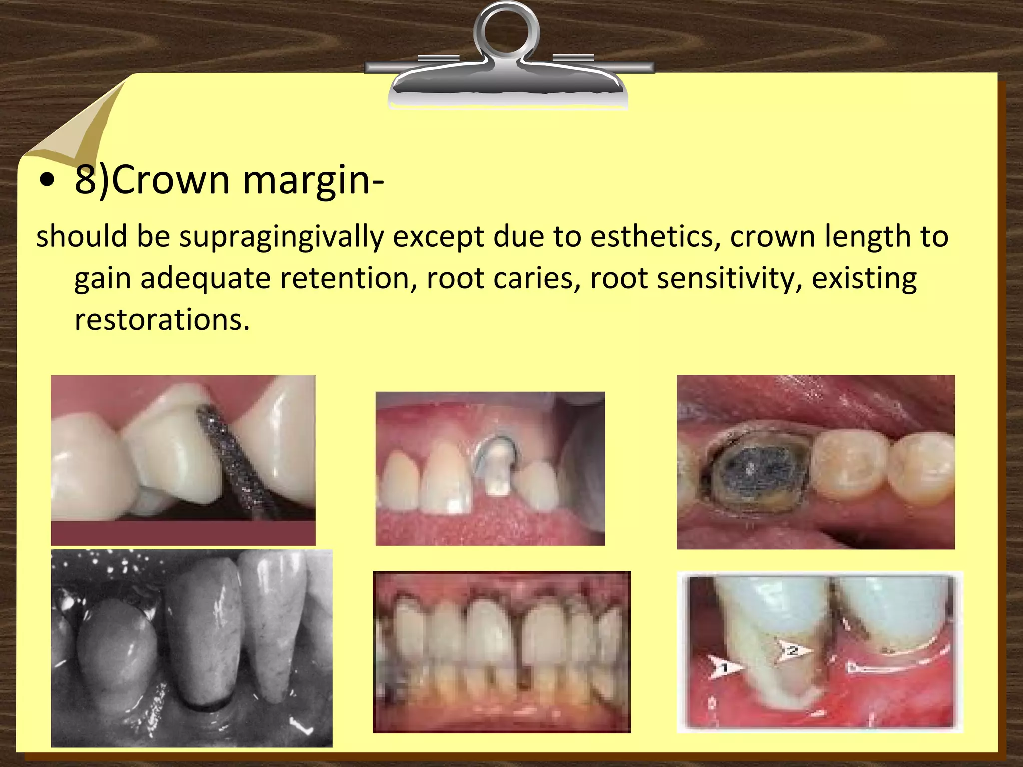 Emergence profile in fixed partial denture. | PPT