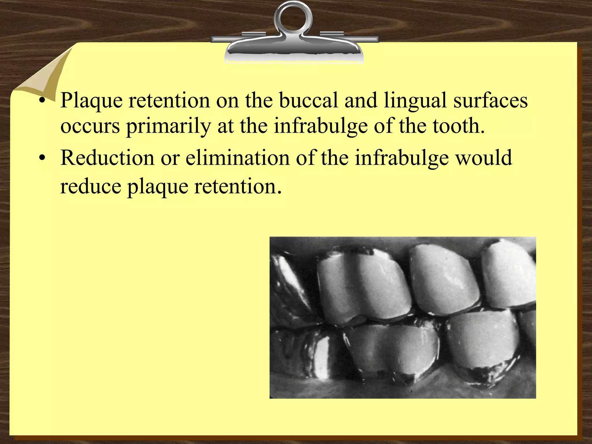 Emergence profile in fixed partial denture. | PPT