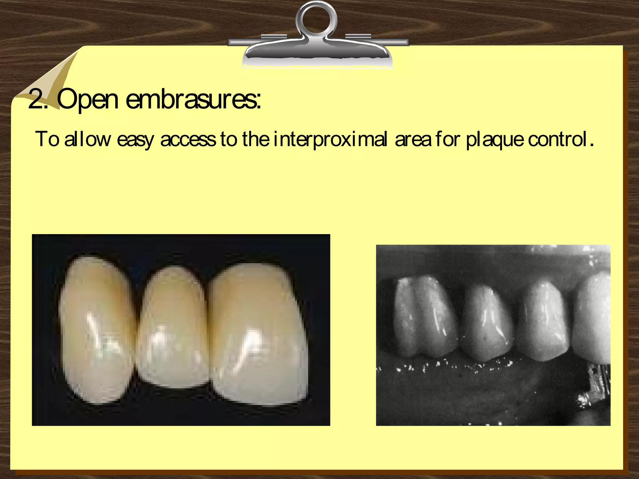 Emergence profile in fixed partial denture. | PPT