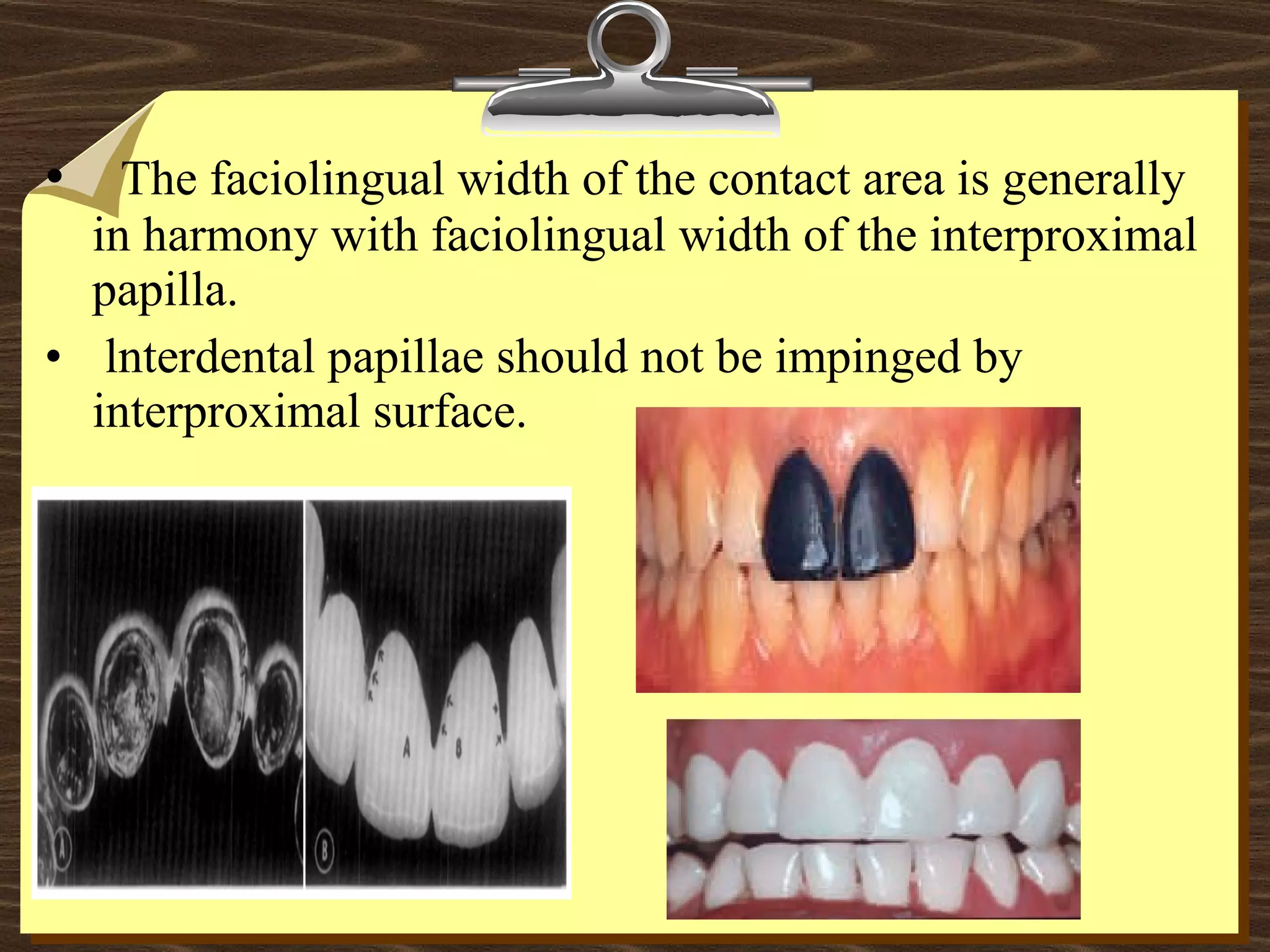 Emergence profile in fixed partial denture. | PPT