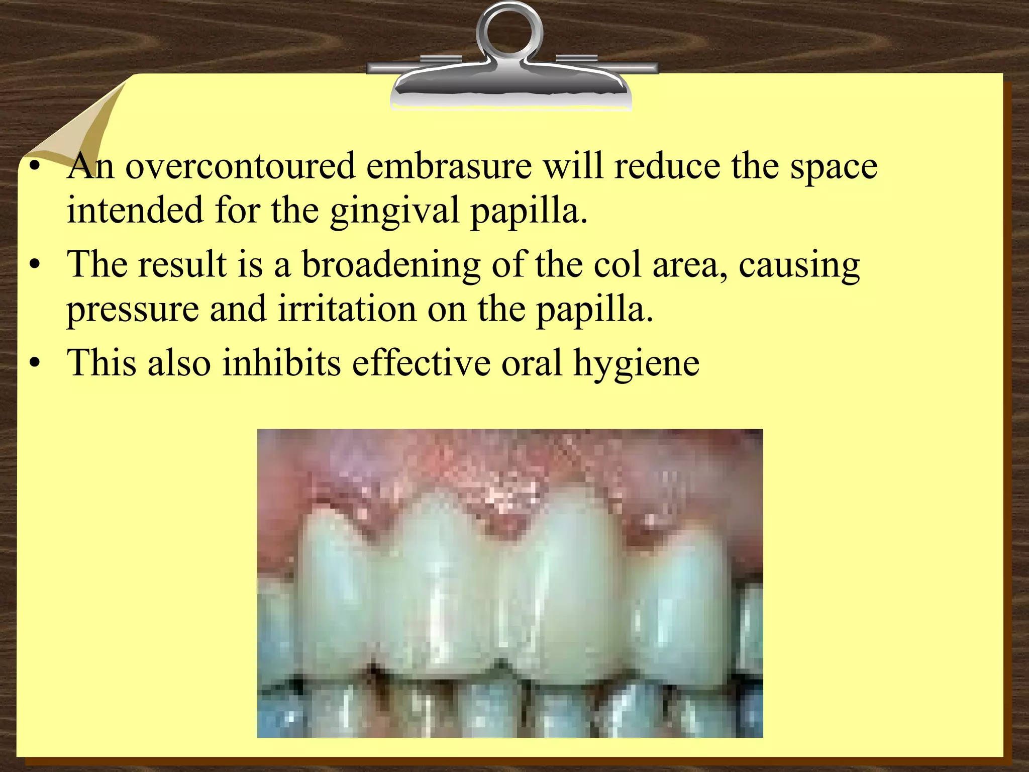 Emergence profile in fixed partial denture. | PPT