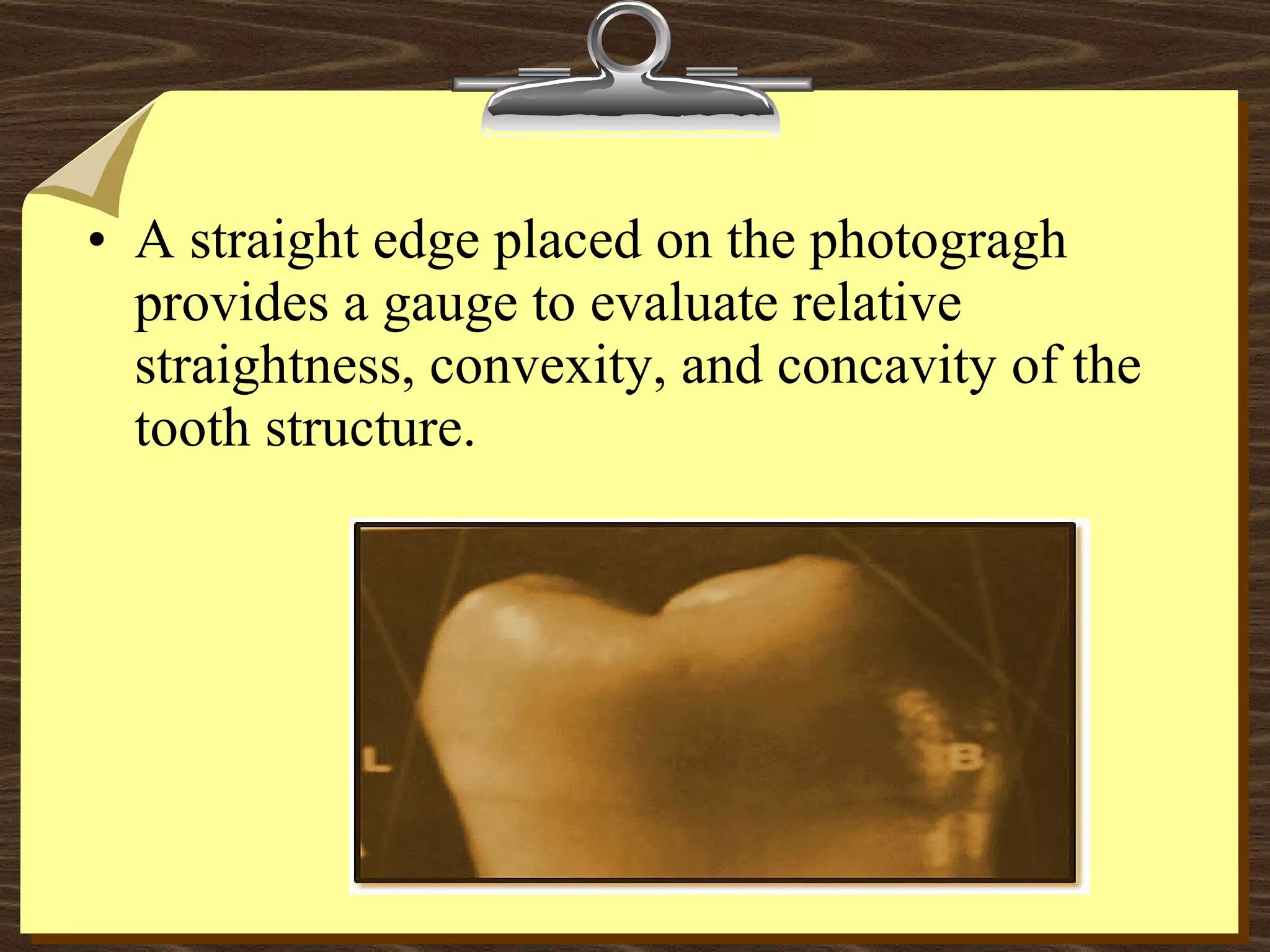 Emergence profile in fixed partial denture. | PPT
