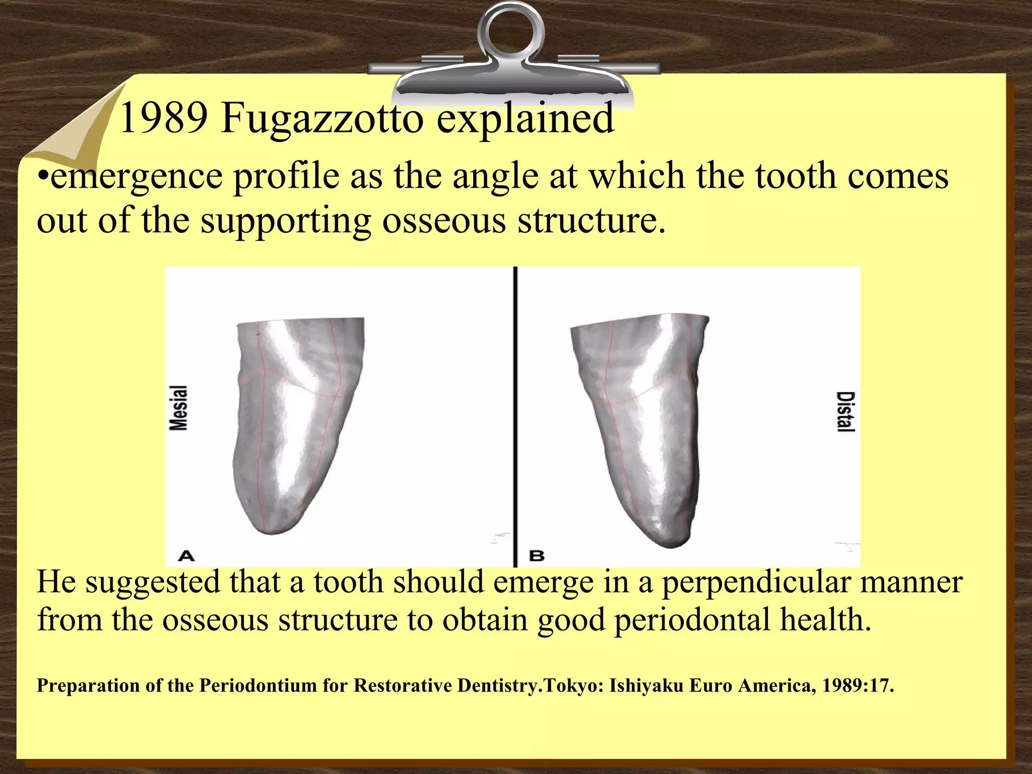 Emergence profile in fixed partial denture. | PPT
