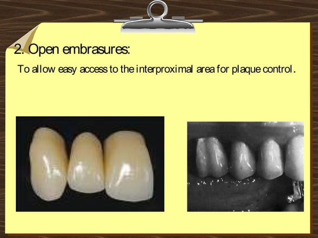 Emergence profile in fixed partial denture. | PPT | Dental Health ...