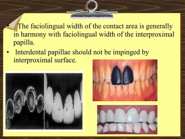 Emergence profile in fixed partial denture. | PPT | Dental Health ...