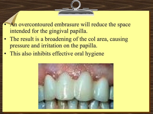 Emergence profile in fixed partial denture. | PPT | Dental Health ...