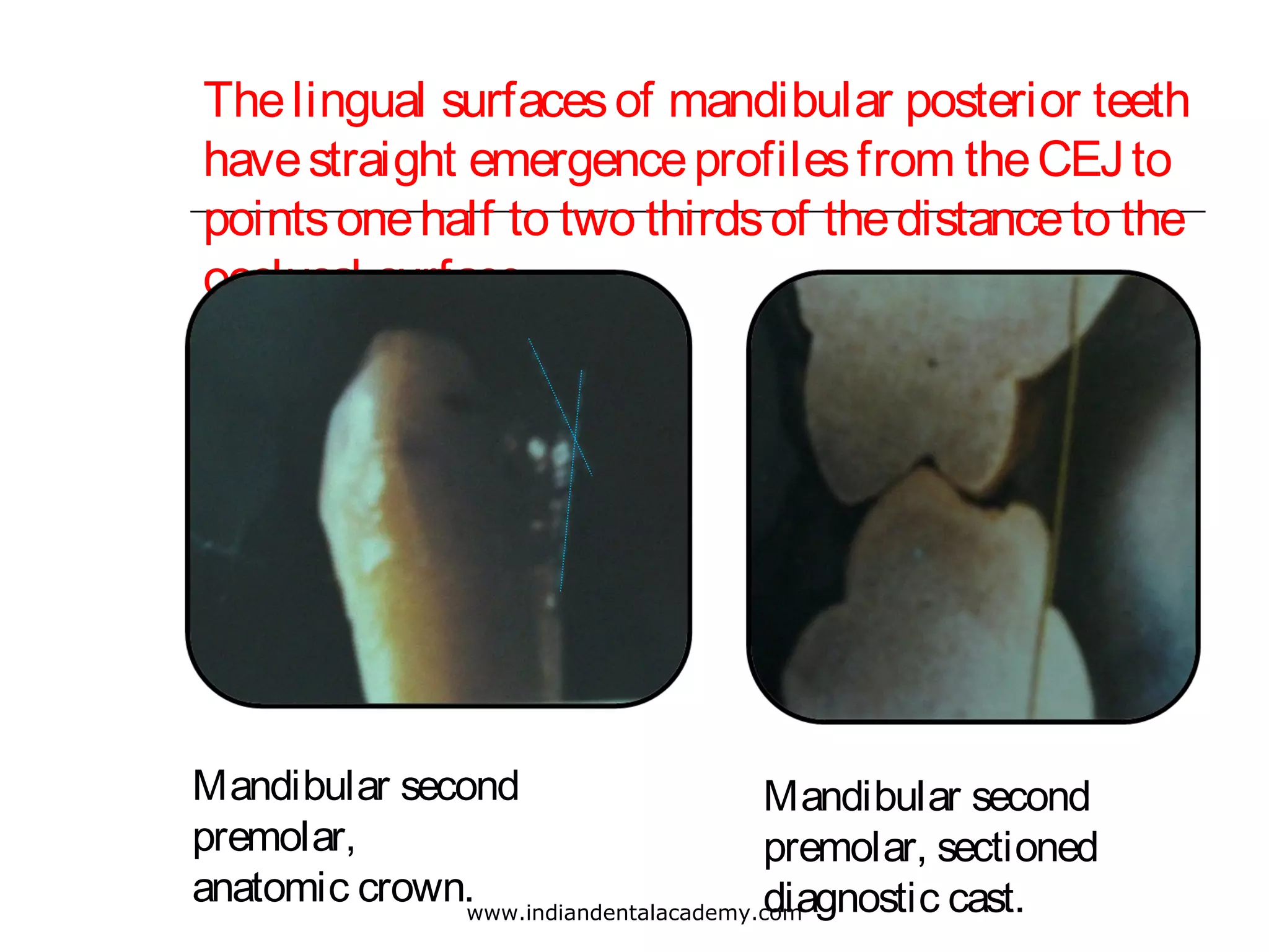Emergence profile done/ new dentistry technology | PPT