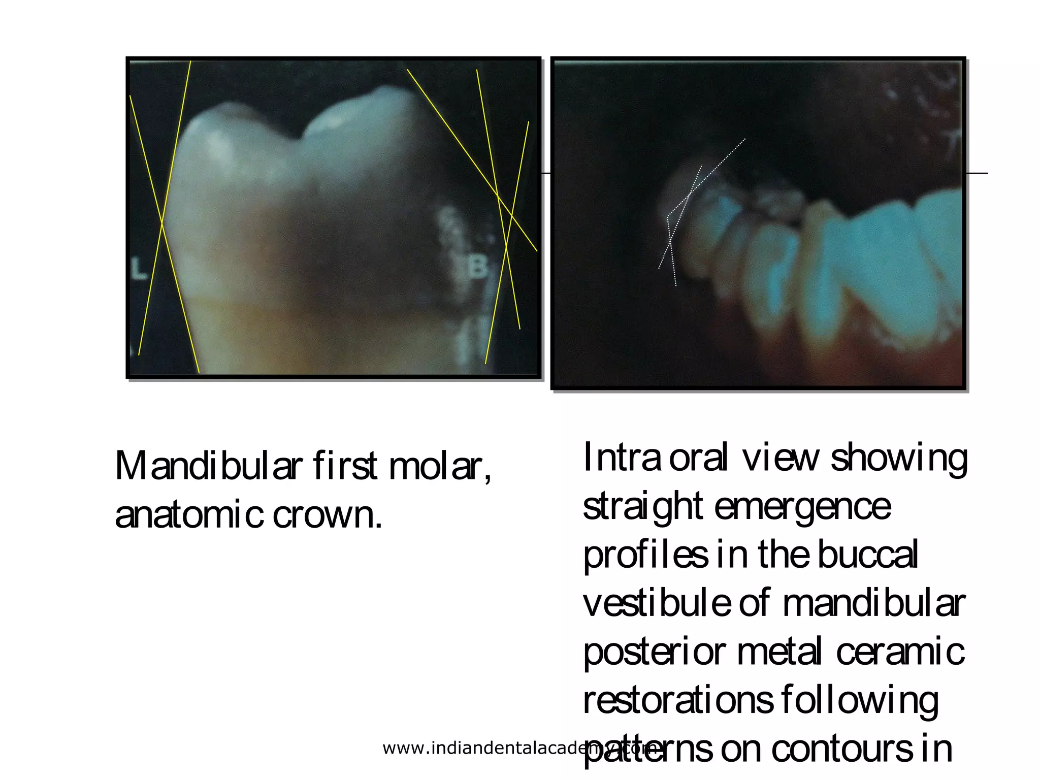 Emergence profile done/ new dentistry technology | PPT