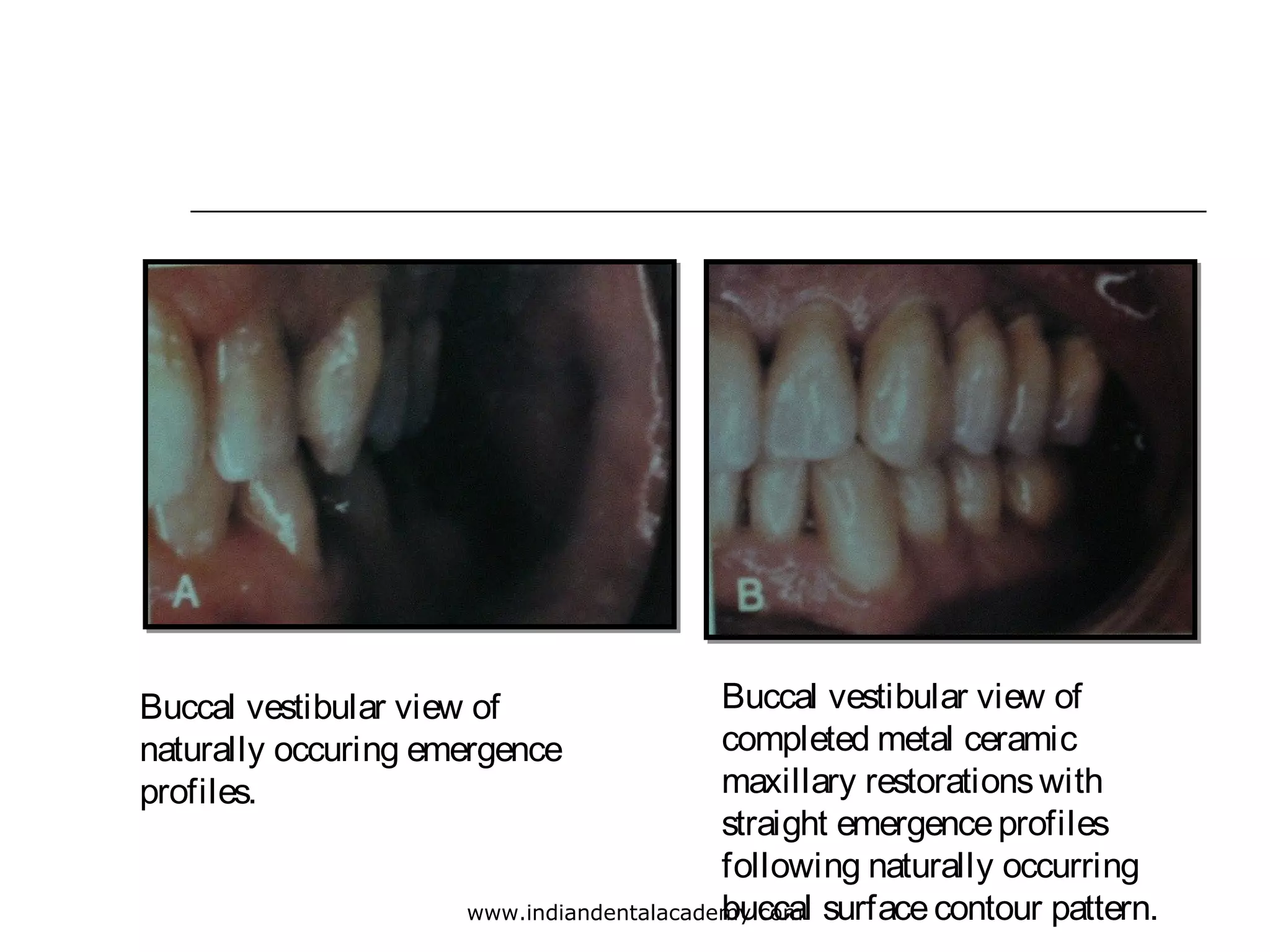Emergence profile done/ new dentistry technology | PPT