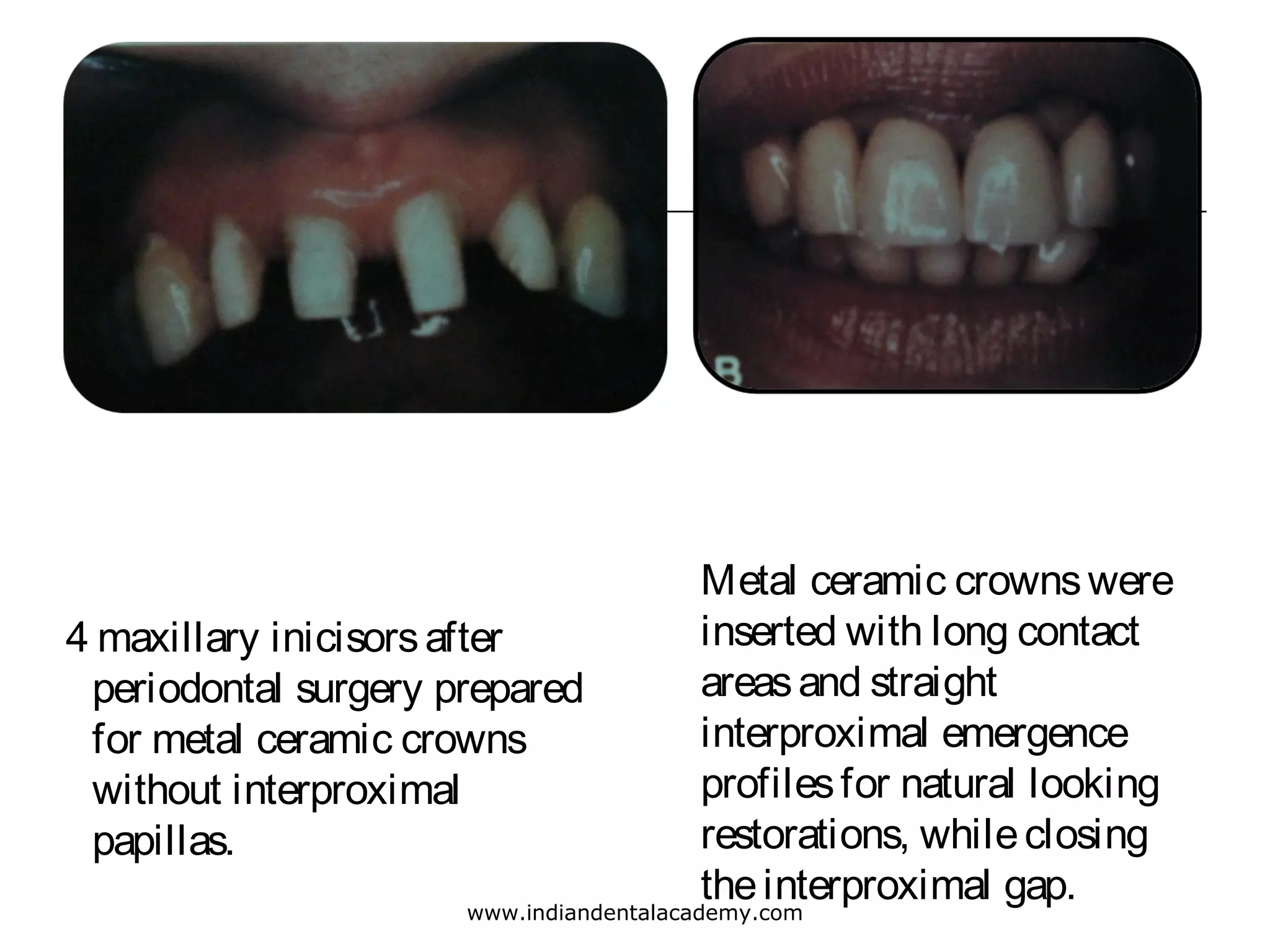 Emergence profile done/ new dentistry technology | PPT