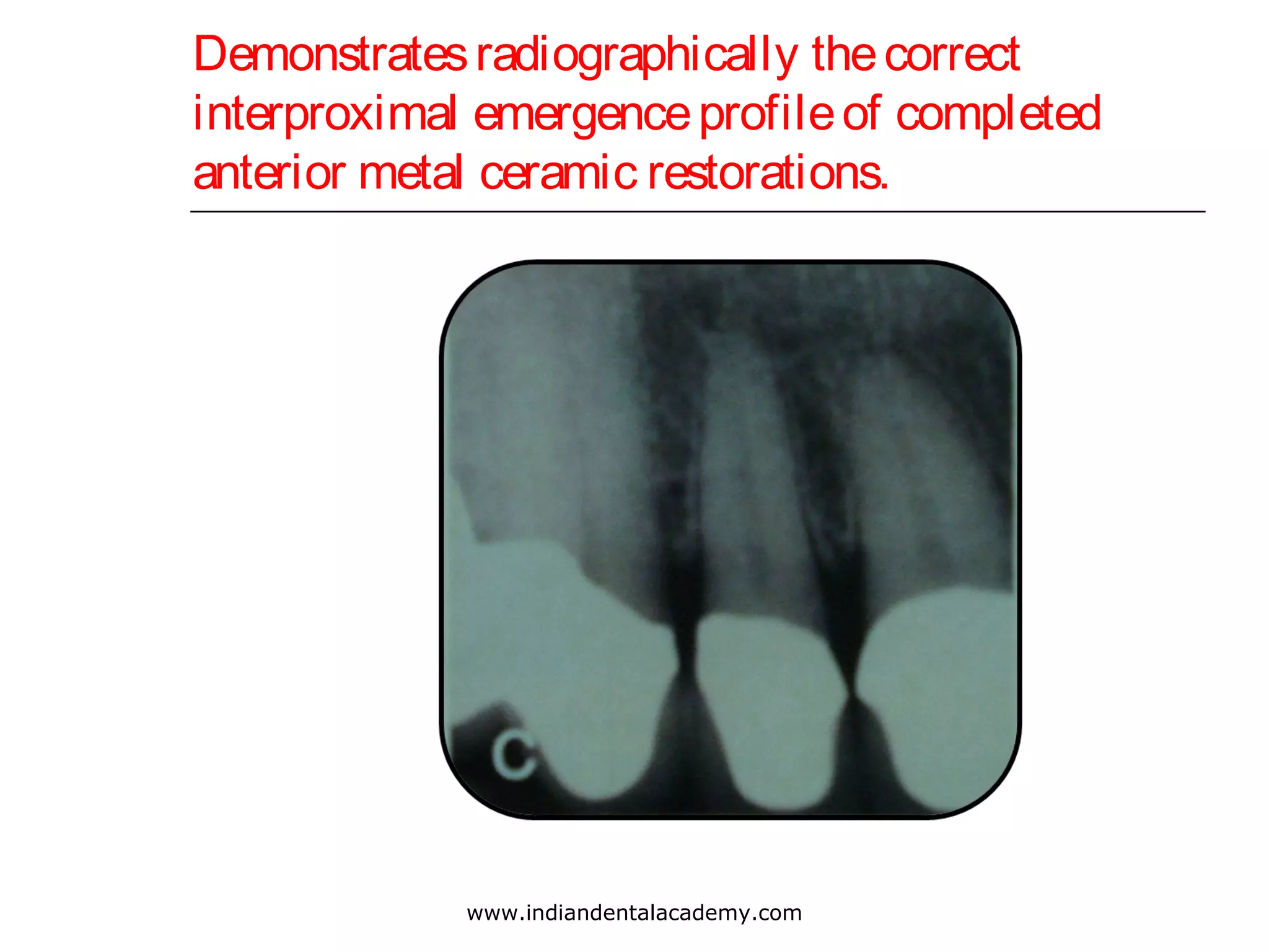 Emergence profile done/ new dentistry technology | PPT