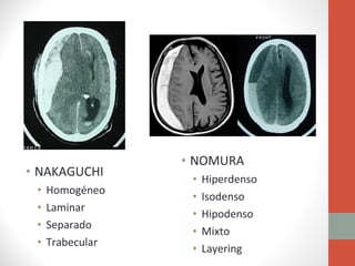 HEMATOMA SUBDURAL CRÓNICO | PPT