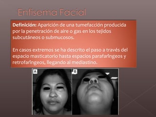 Enfisema e Inyección de Hipoclorito | PPT