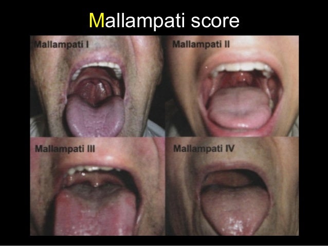 Emergency Airway Management 2014: Mark P. Brady PA-C