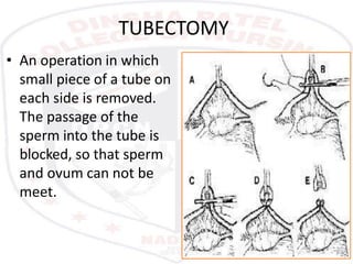 Emergency and terminal contraception | PPSX