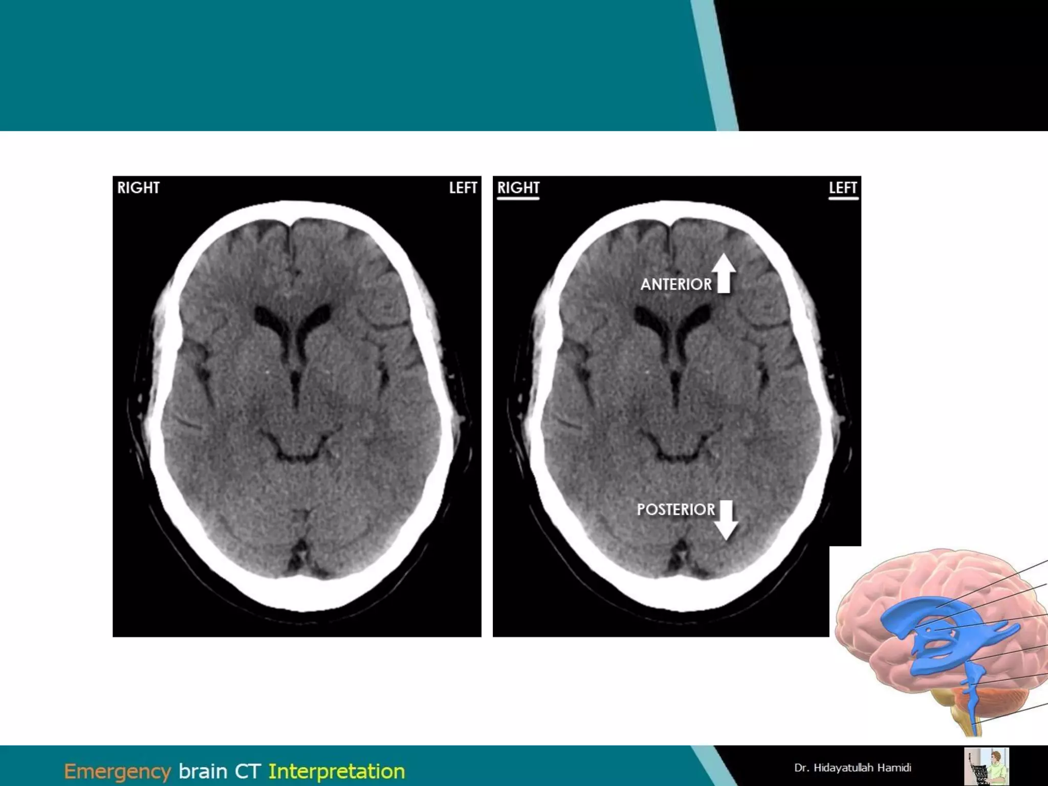 Emergency brain CT interpretation | PDF