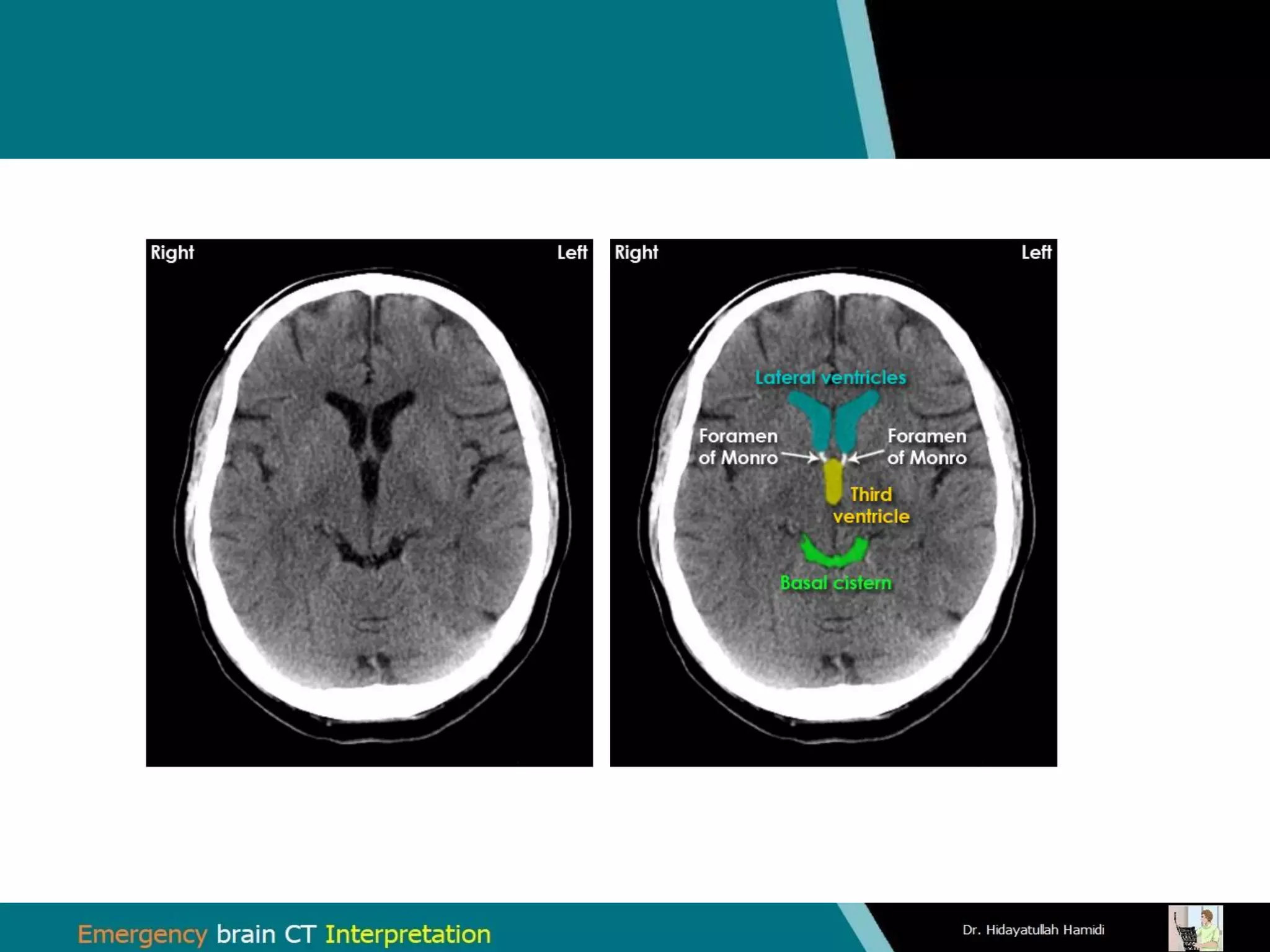 Emergency brain CT interpretation | PDF