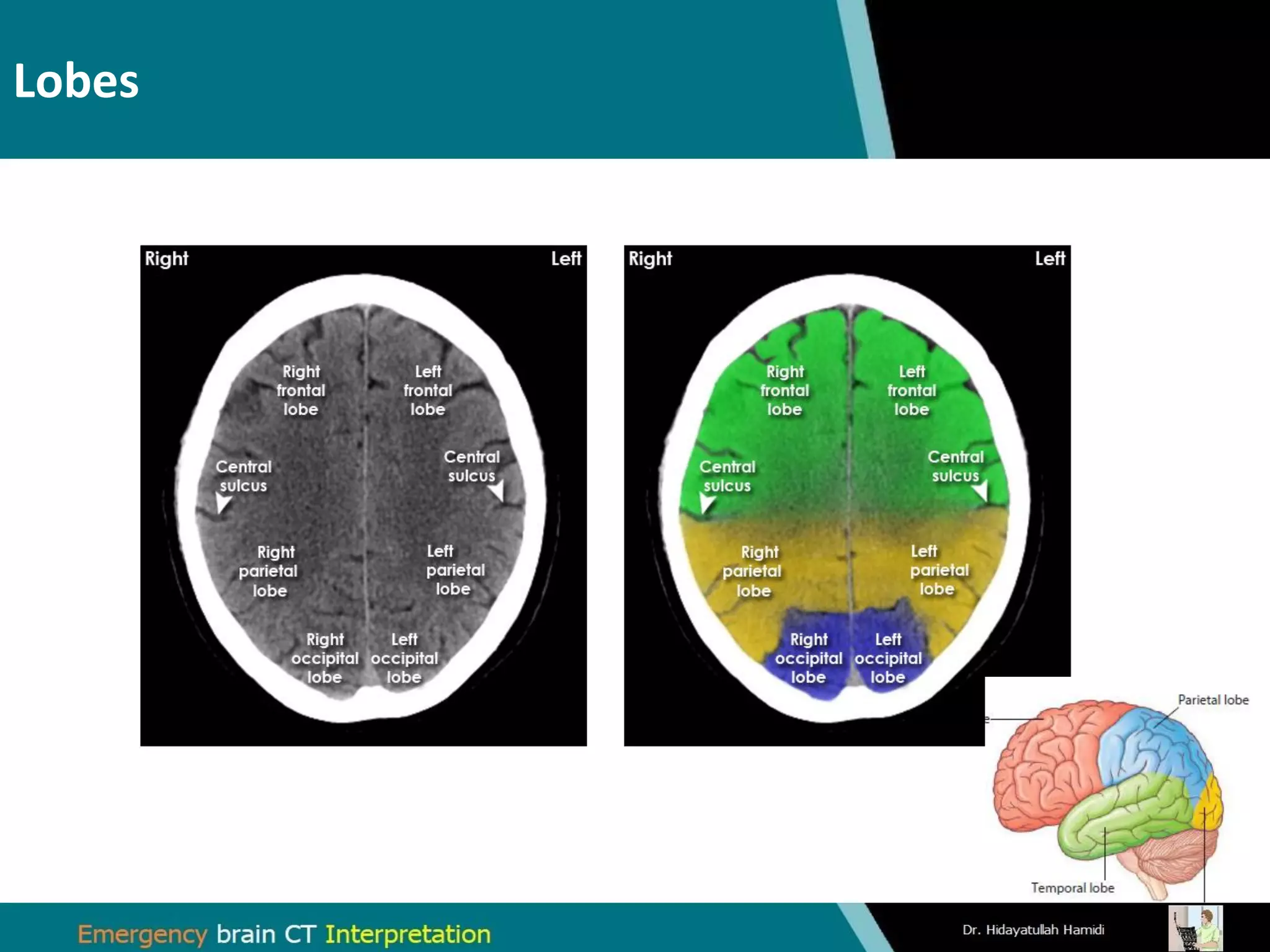 Emergency brain CT interpretation | PDF