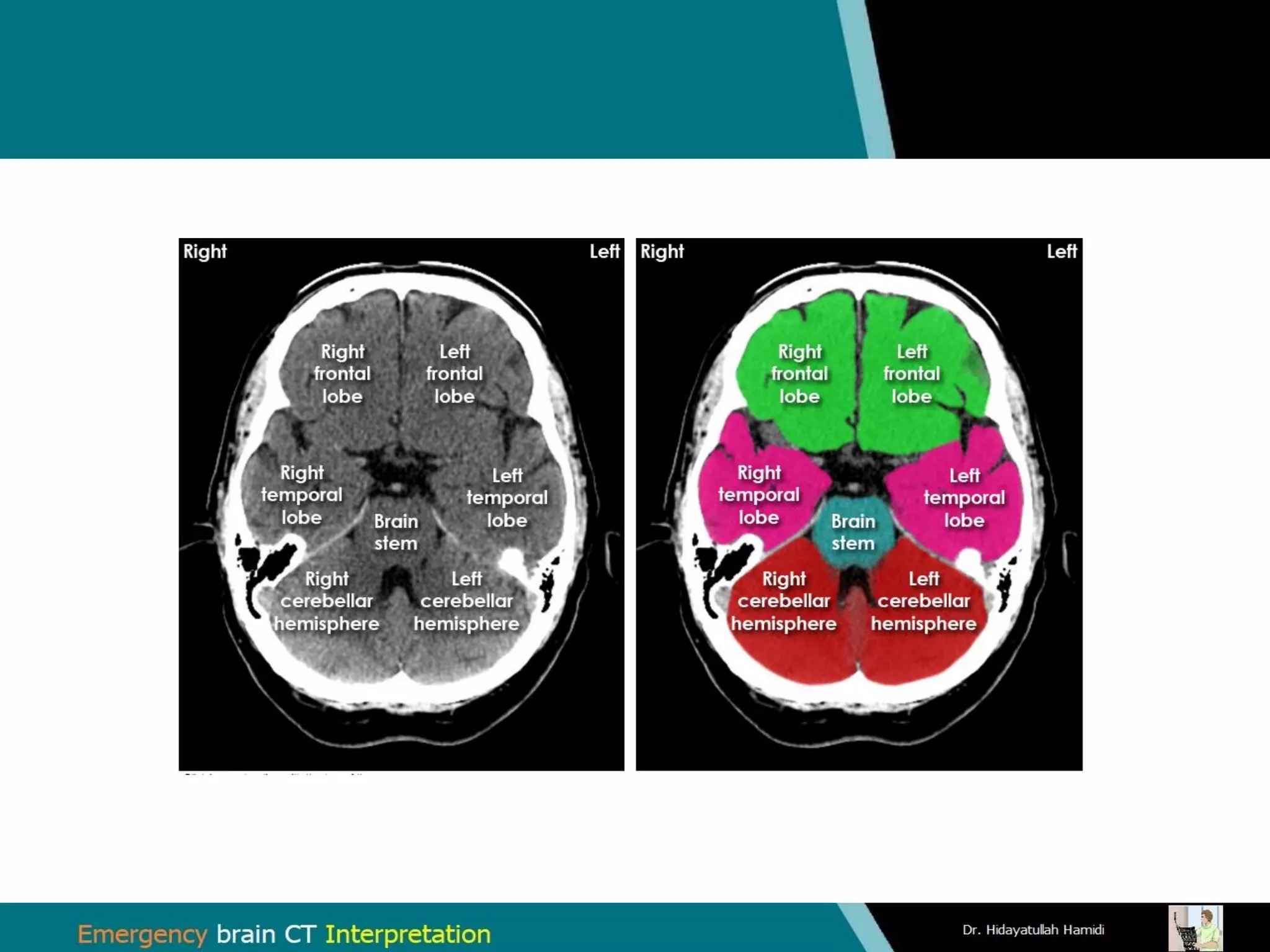 Emergency brain CT interpretation | PDF