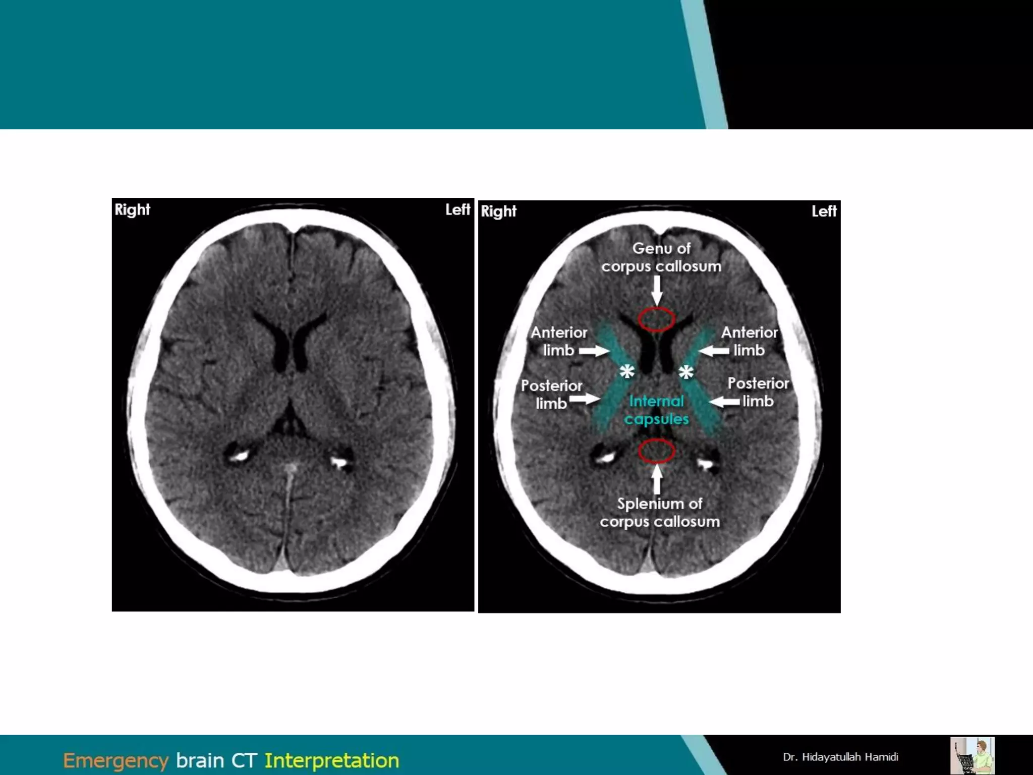 Emergency brain CT interpretation | PDF
