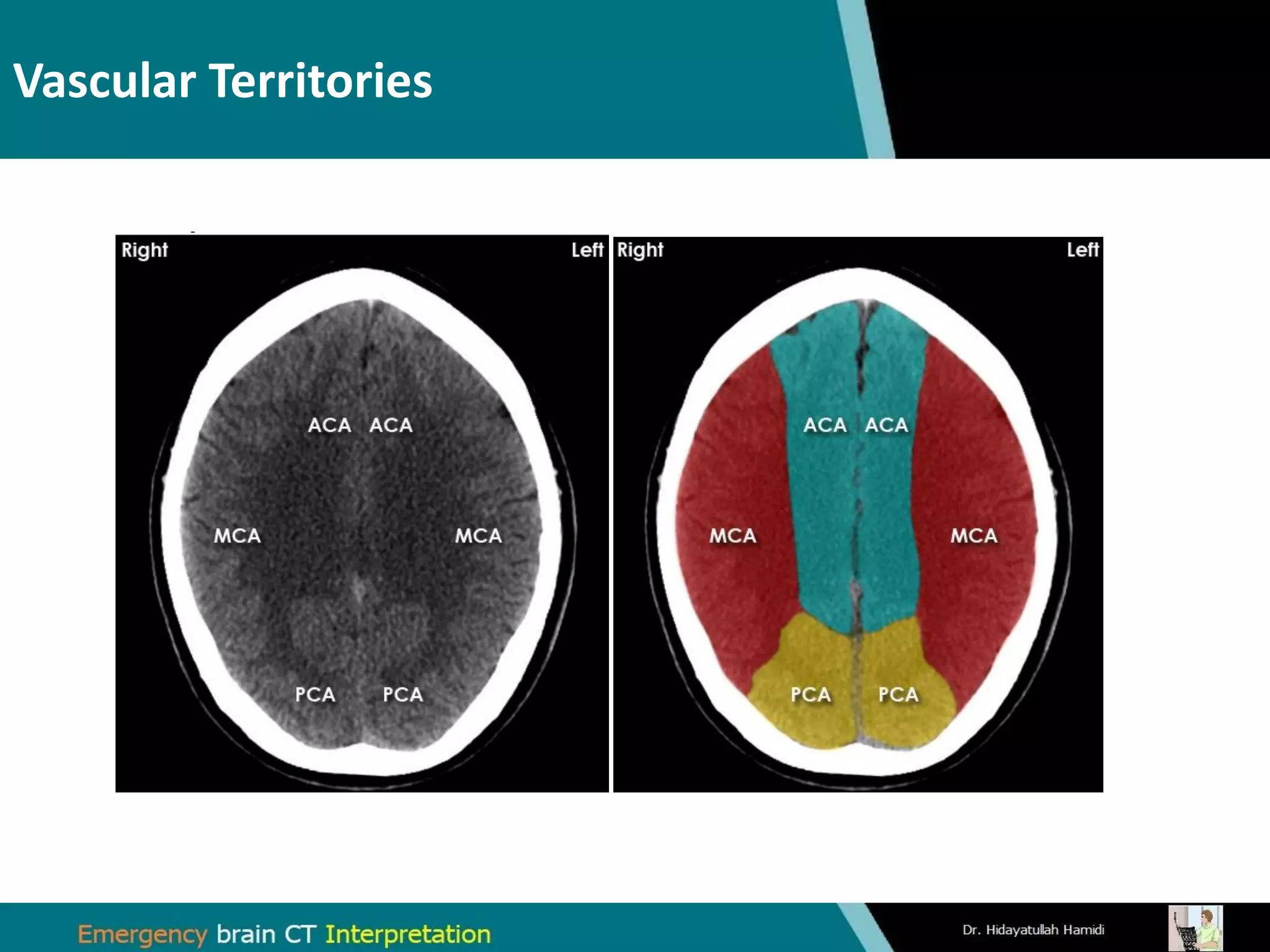 Emergency brain CT interpretation | PDF