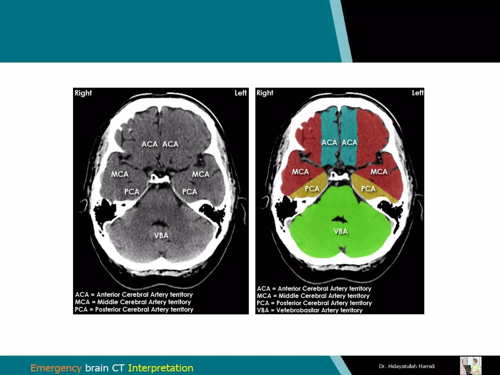 Emergency brain CT interpretation | PDF
