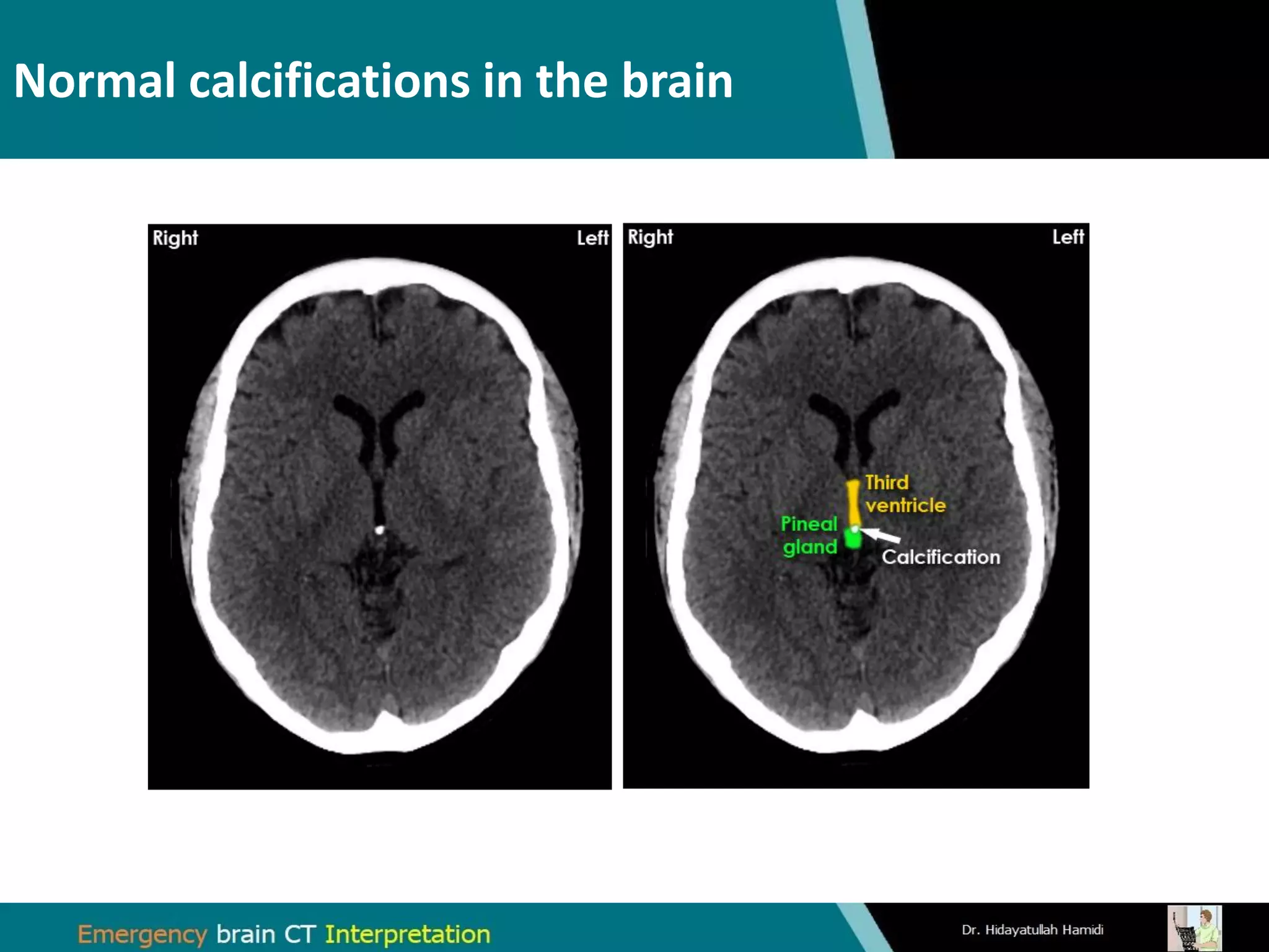 Emergency brain CT interpretation | PDF
