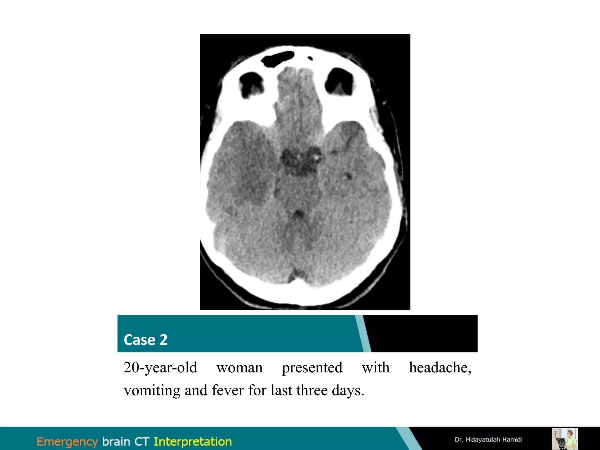 Emergency brain CT interpretation | PDF