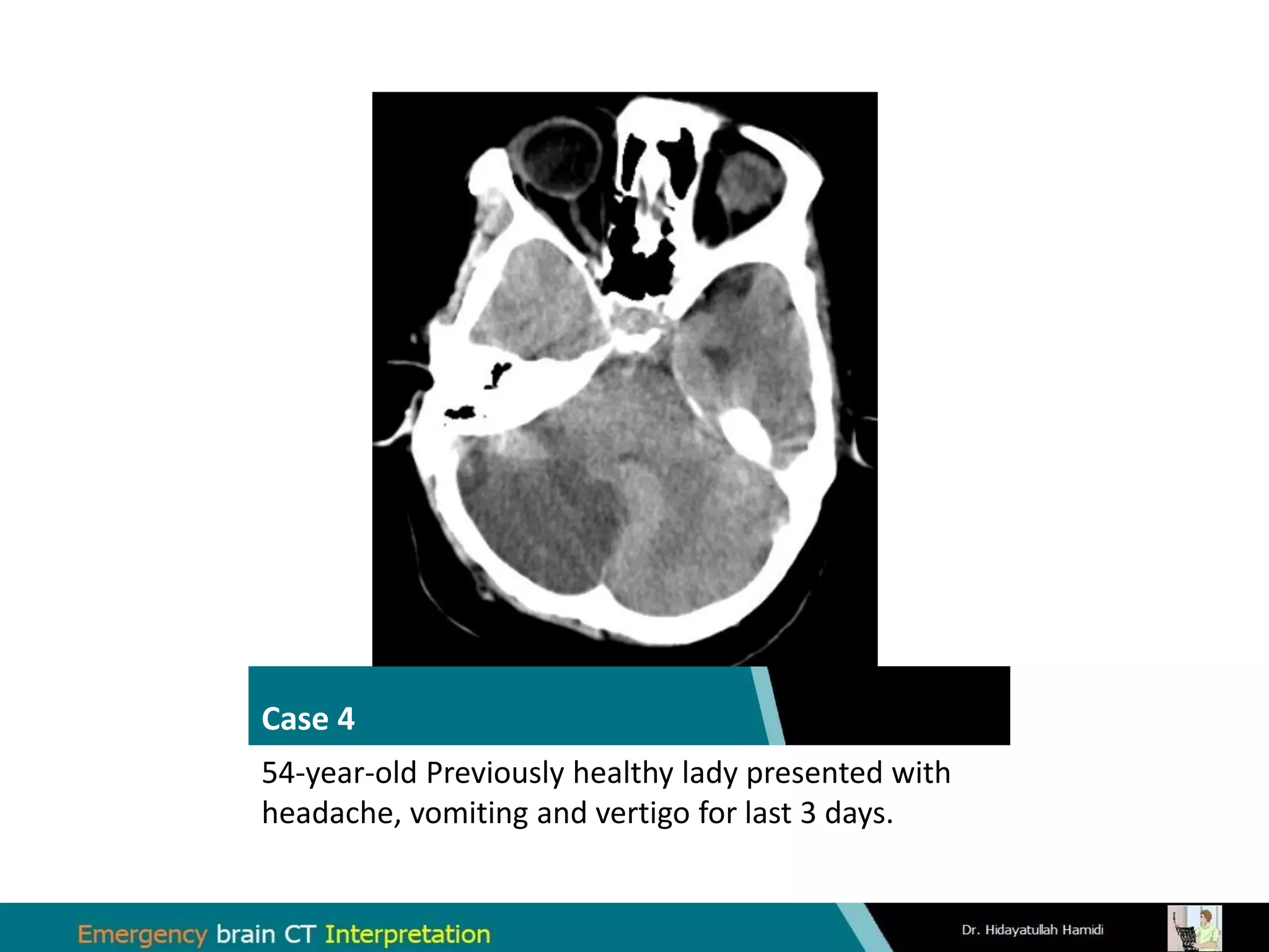 Emergency brain CT interpretation | PDF