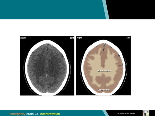 Emergency brain CT interpretation | PDF