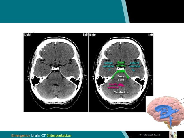 Emergency brain CT interpretation | PDF