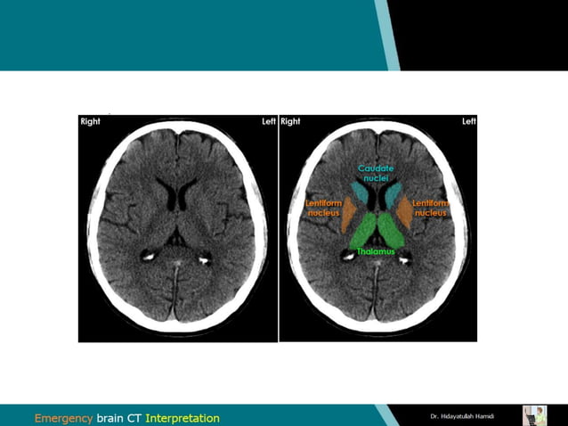 Emergency brain CT interpretation | PDF