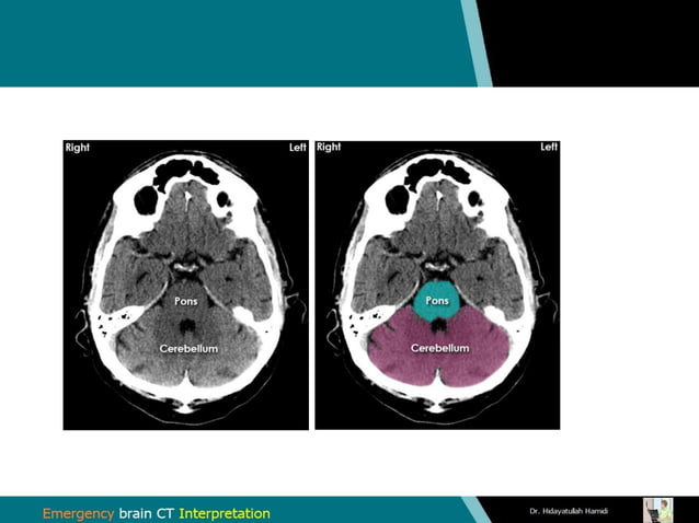 Emergency brain CT interpretation | PDF