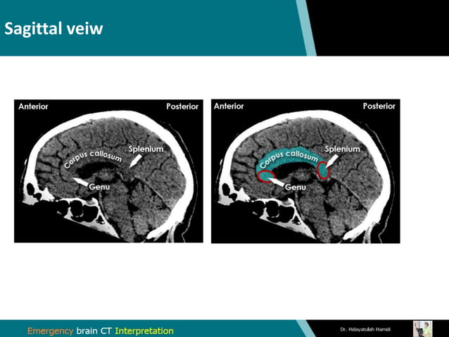 Emergency brain CT interpretation | PDF