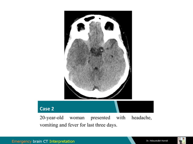 Emergency brain CT interpretation | PDF