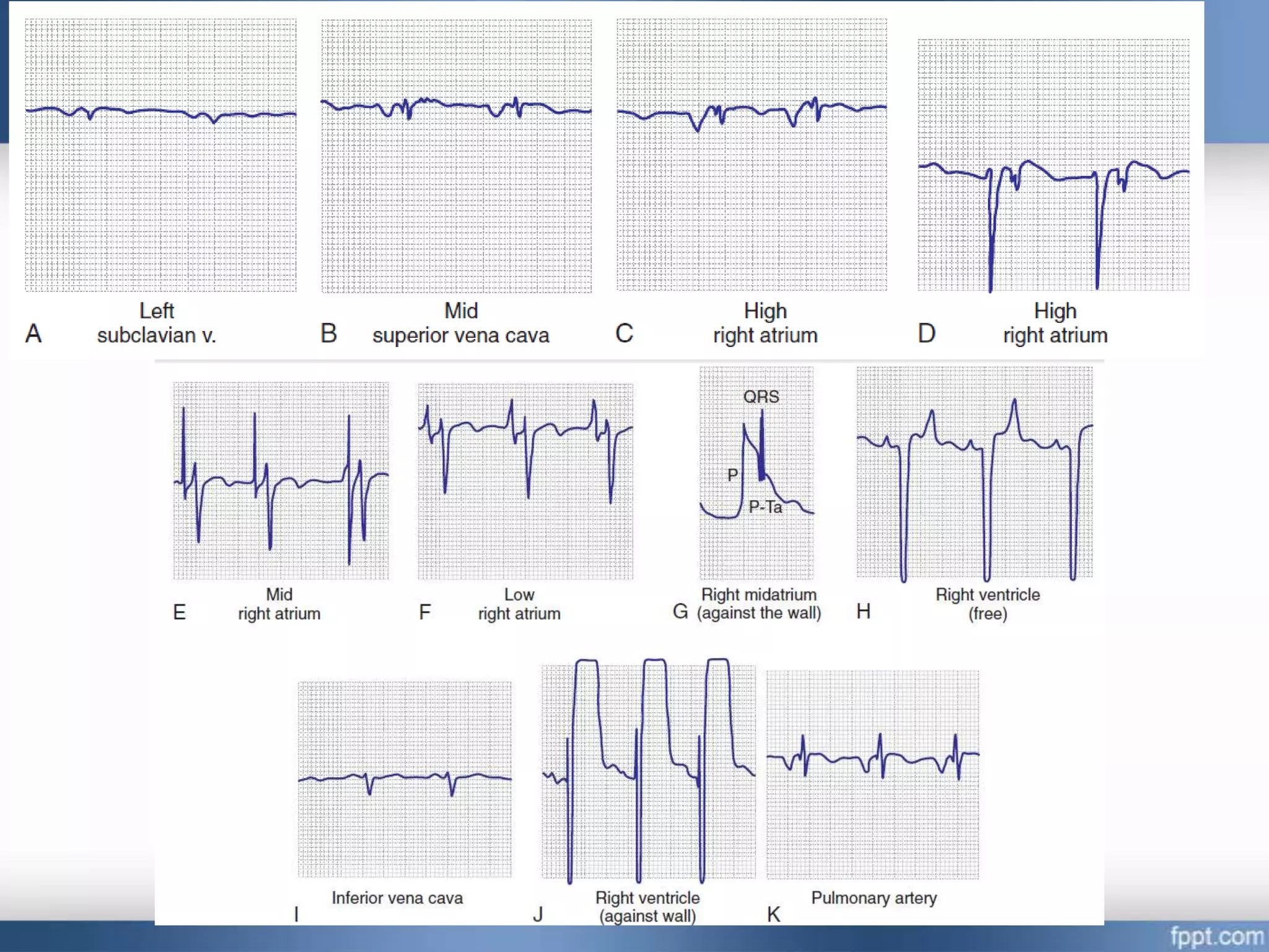 Emergency cardiac pacing | PPTX