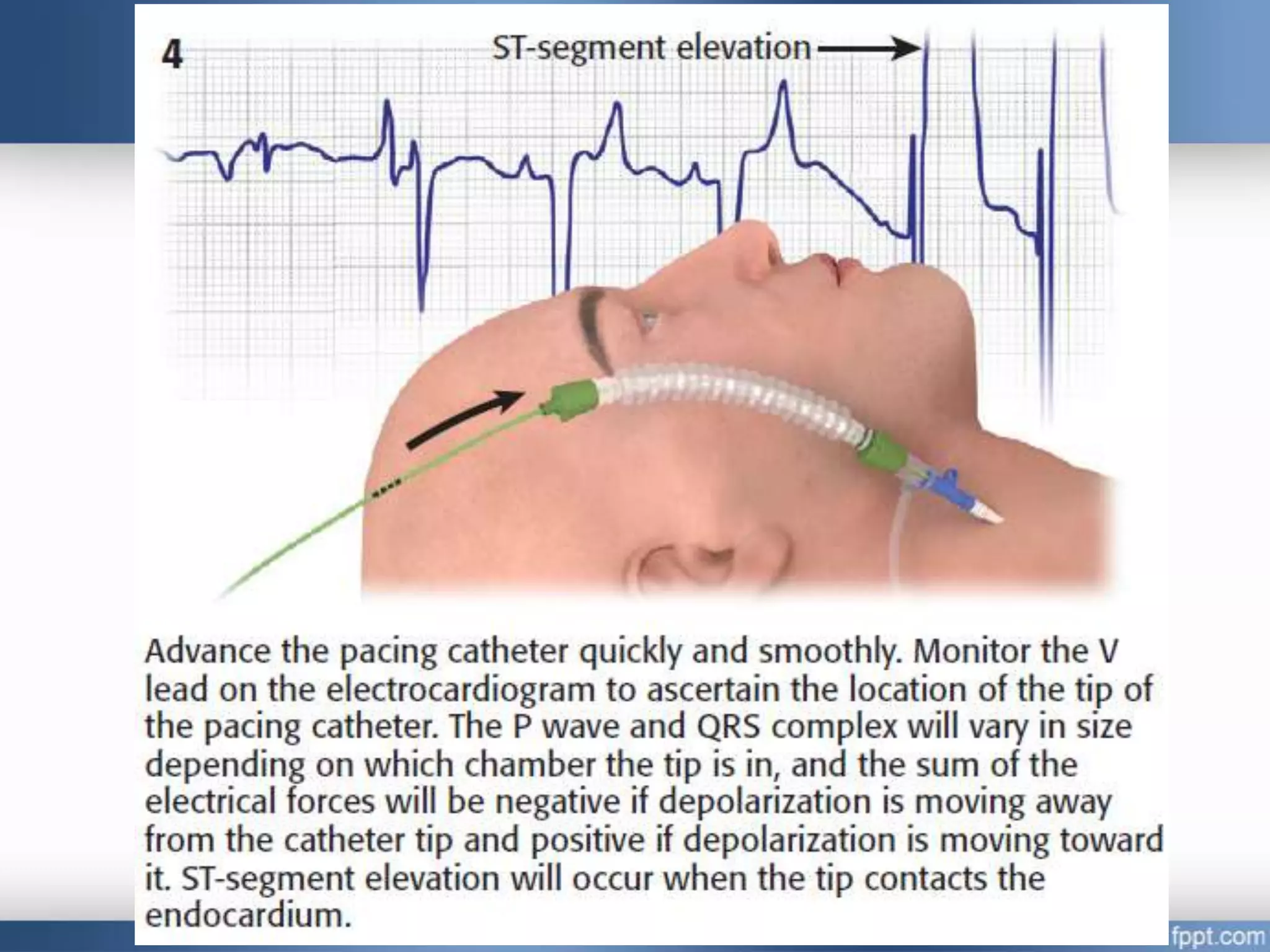 Emergency cardiac pacing | PPTX