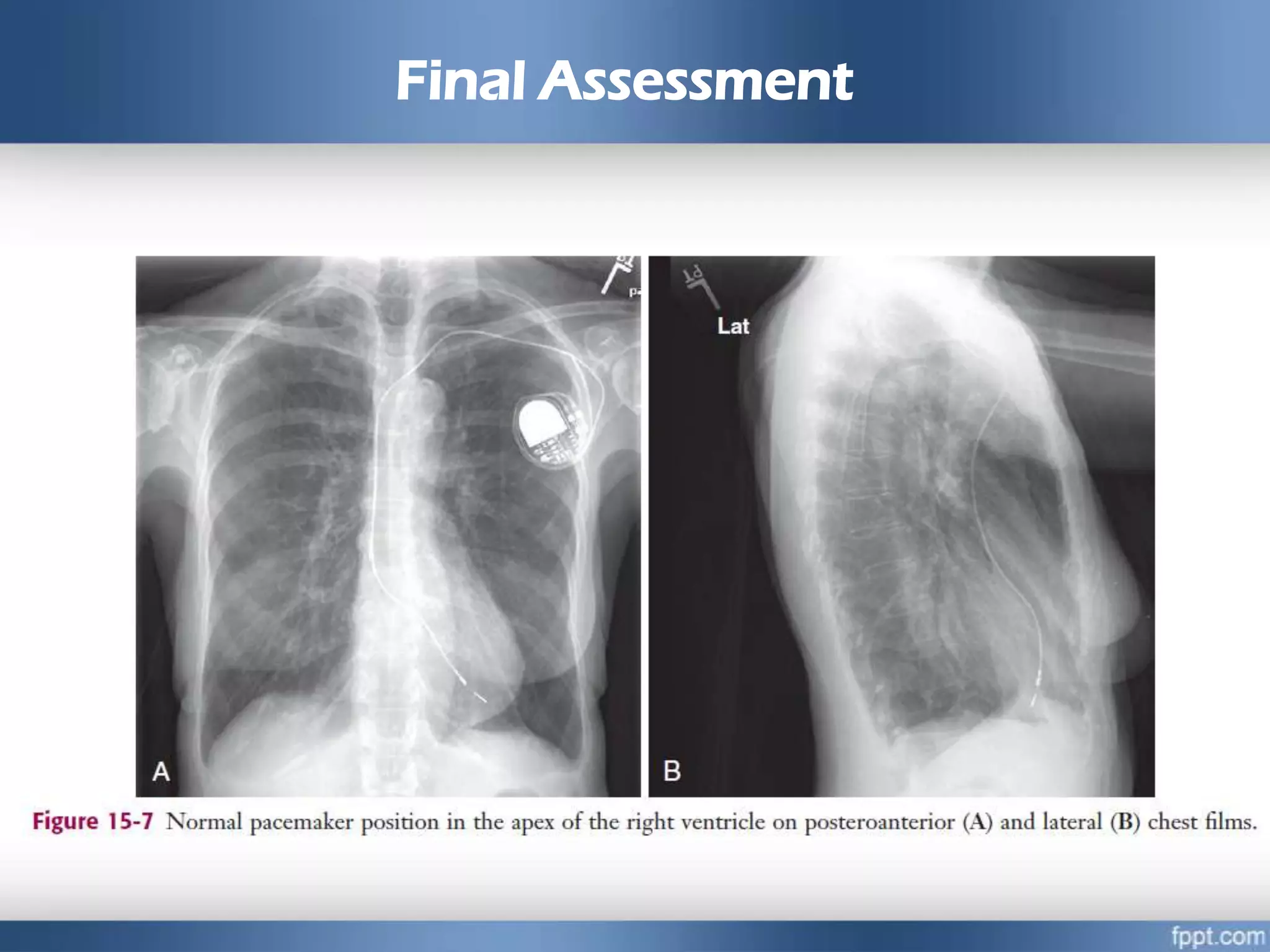 Emergency cardiac pacing | PPTX