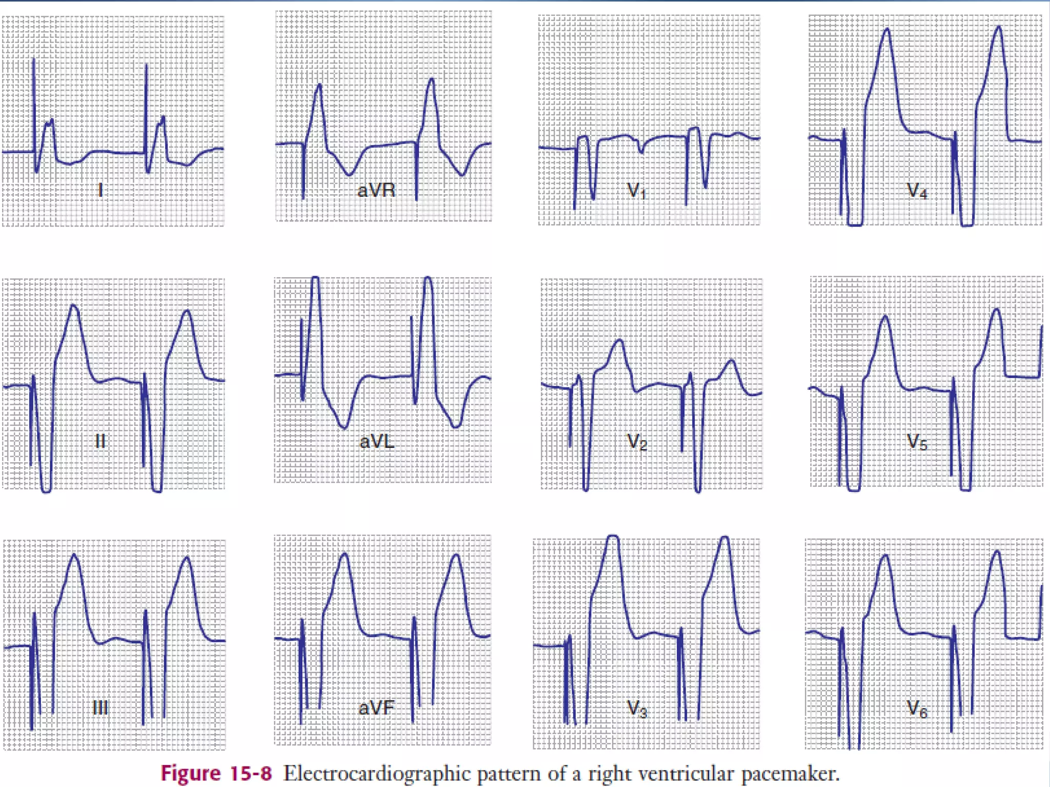 Emergency cardiac pacing | PPTX