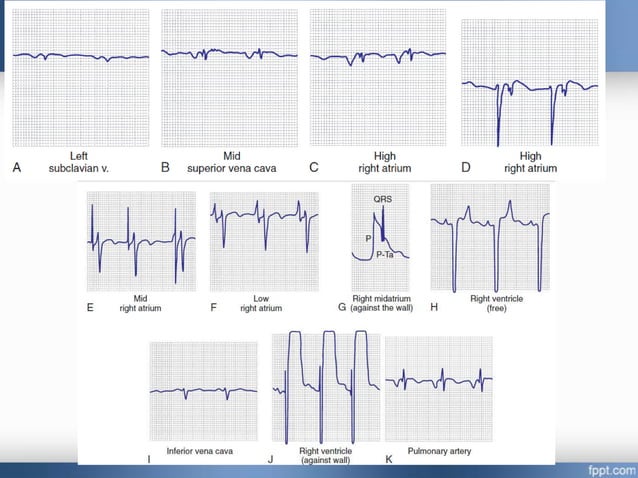 Emergency cardiac pacing | PPTX