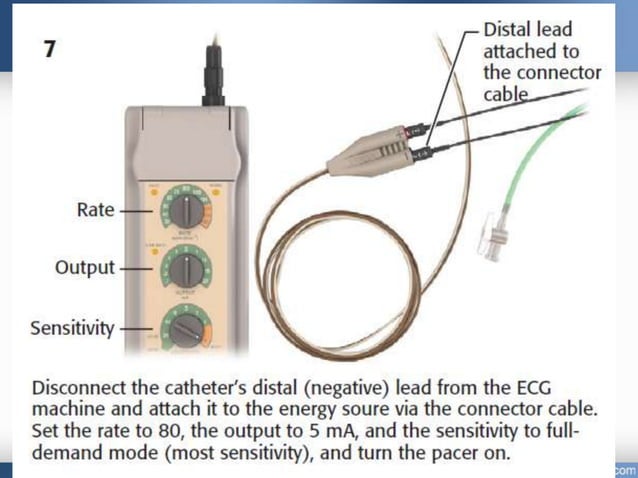 Emergency cardiac pacing | PPTX