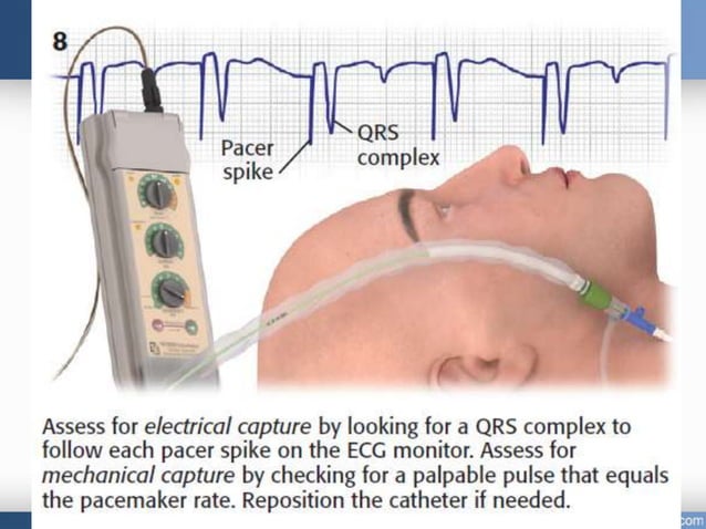 Emergency cardiac pacing | PPTX