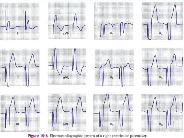 Emergency cardiac pacing | PPTX