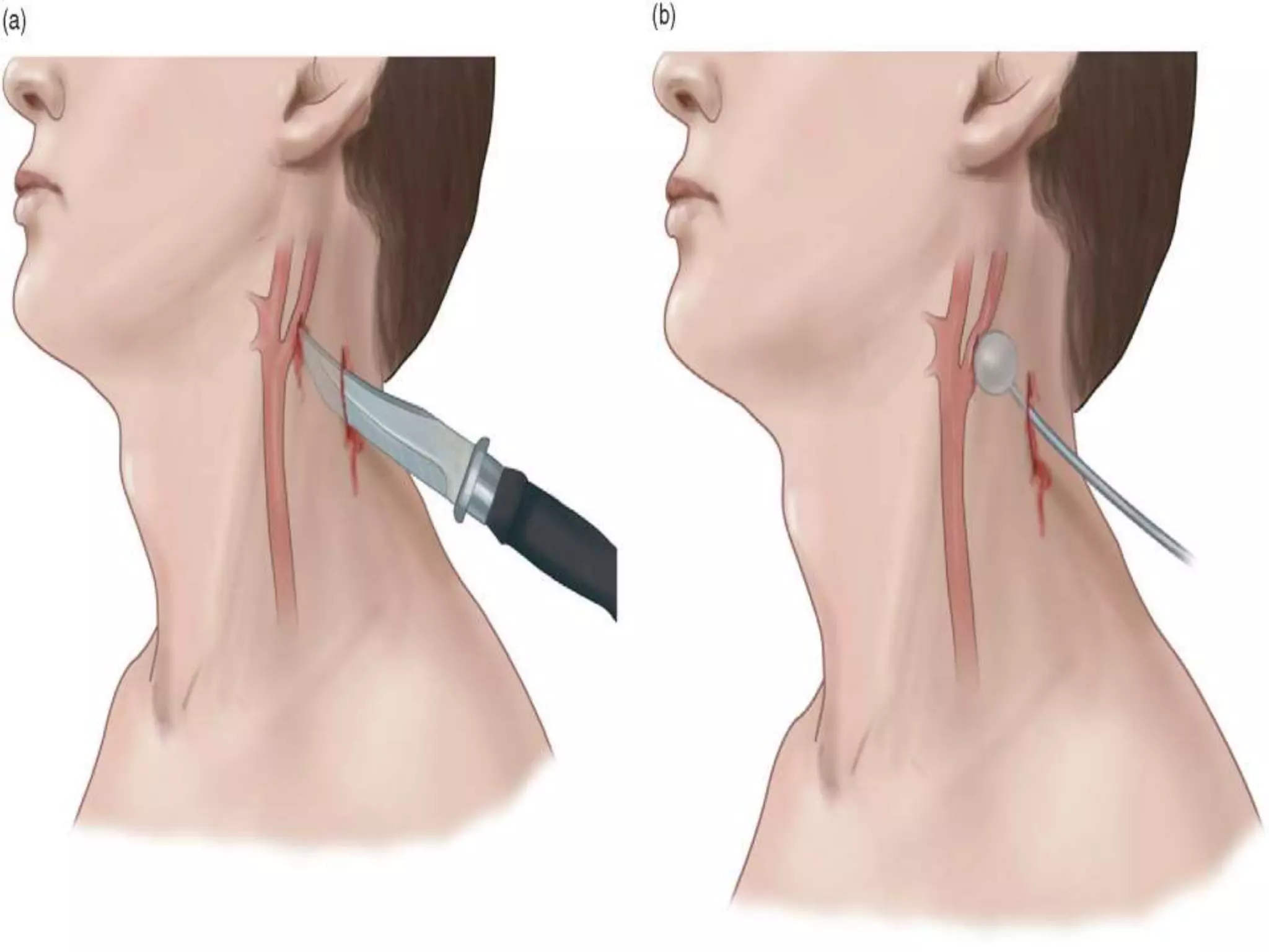 Emergency Care Of Cervical Spine Injuries Pptx