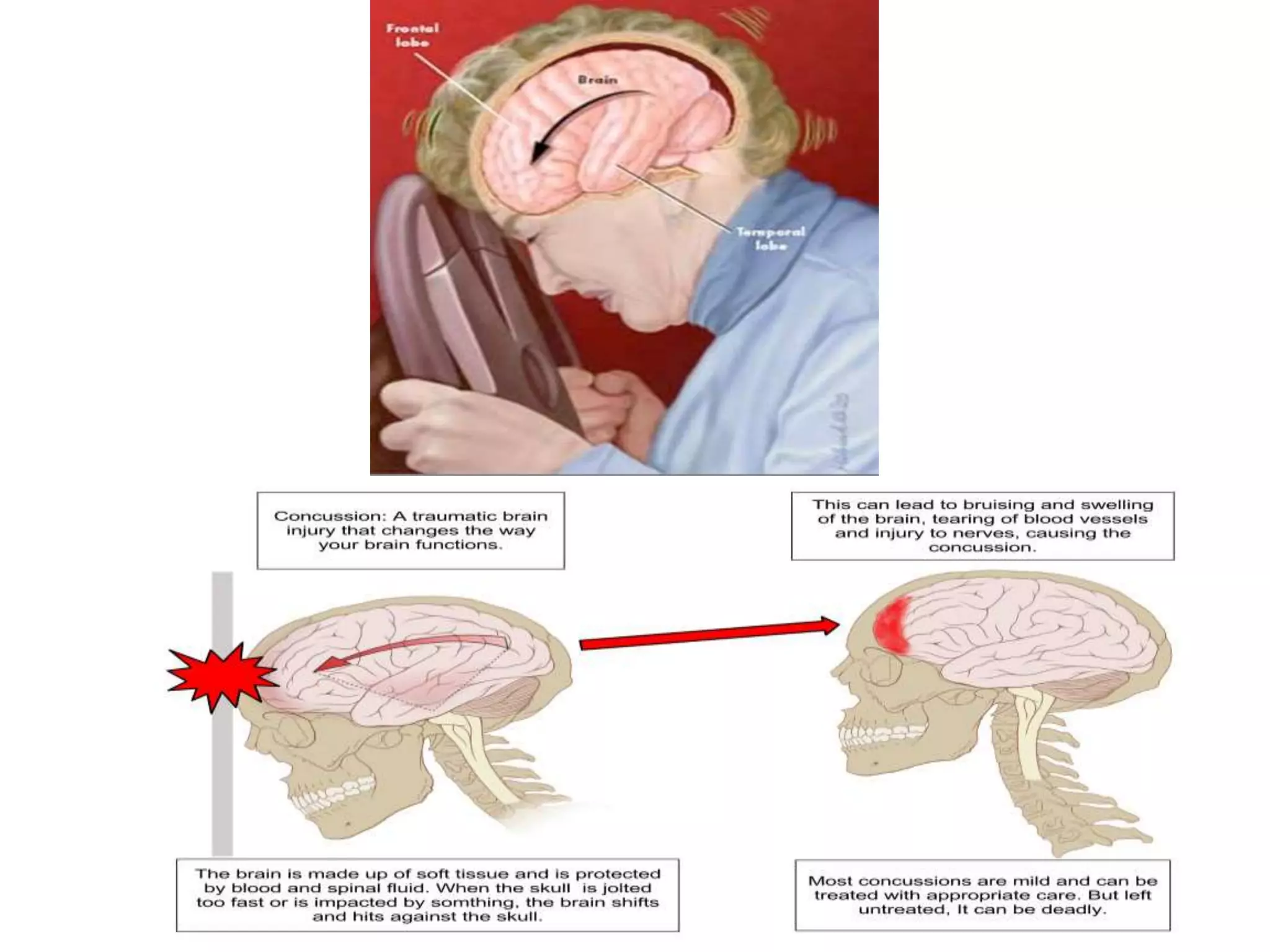 Emergency care of cervical spine injuries | PPTX