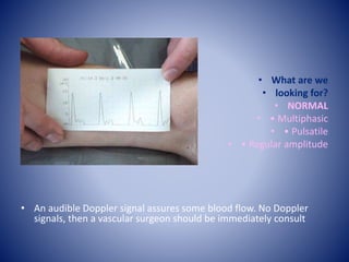 Acute Limb Ischemia - Emergency Case presentation | PPTX