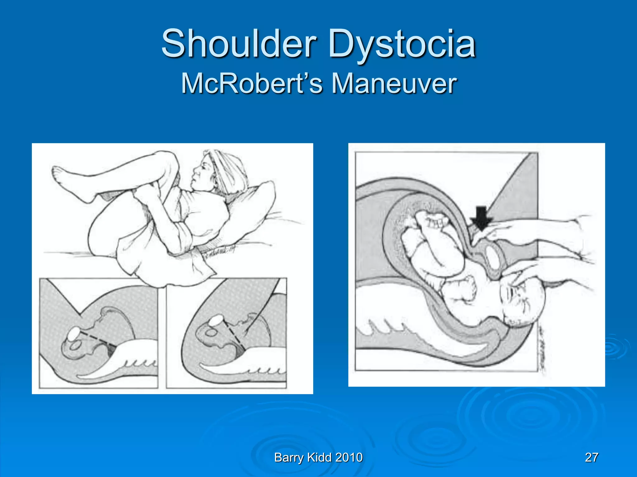 Emergency childbirth | PPT