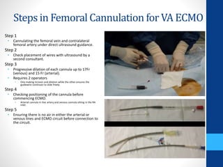 ECMO for Cardiac Arrest | PPT